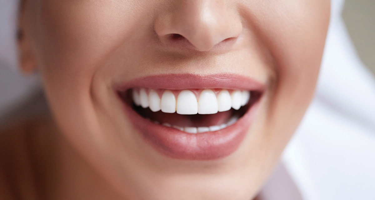 Keramičke fasete - Estetska stomatologija - Dental Centar Petković